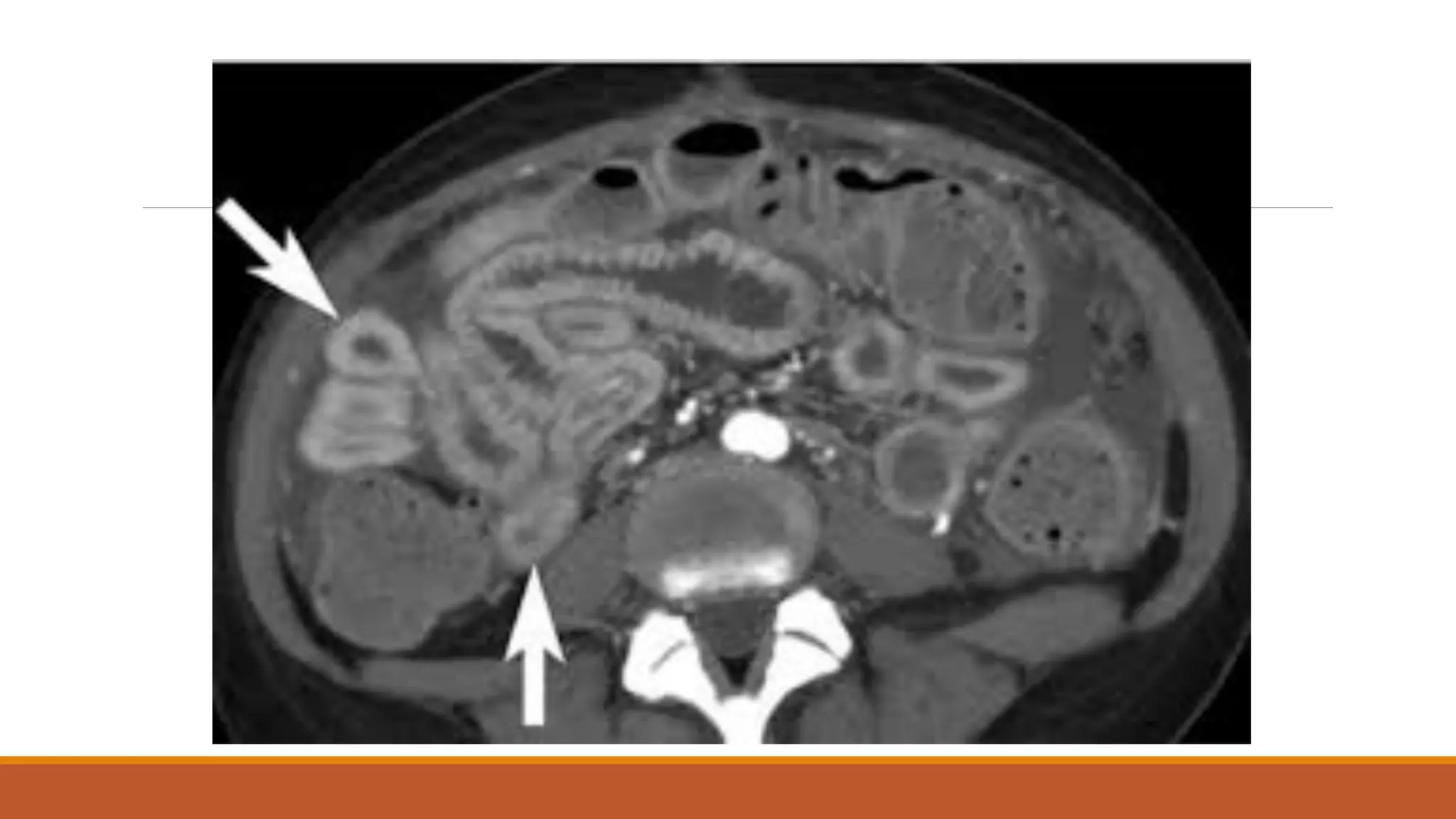 Abdominal radiology pattern recognition | PDF