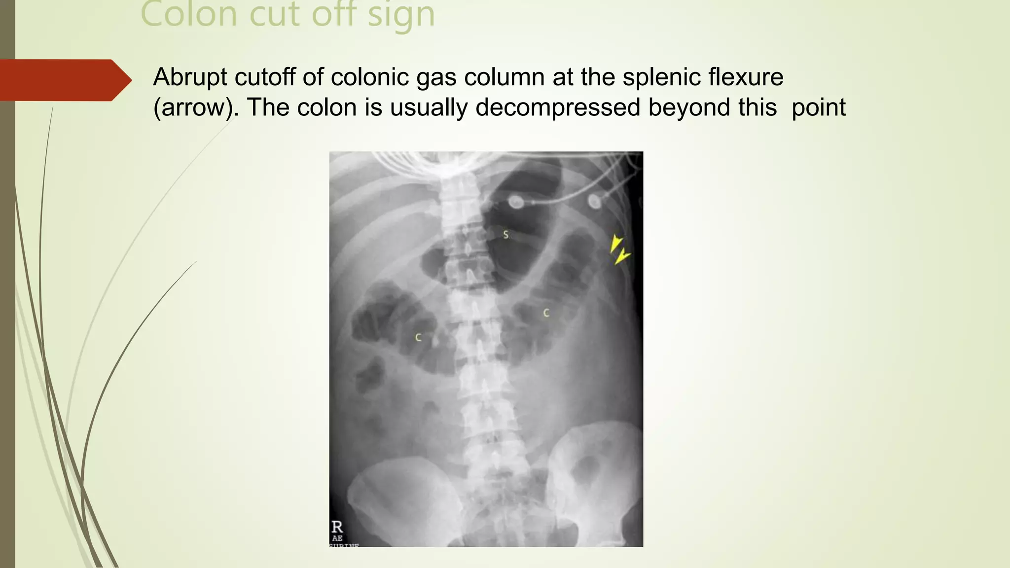 Abdominal x-ray interpretation ppt | PPTX