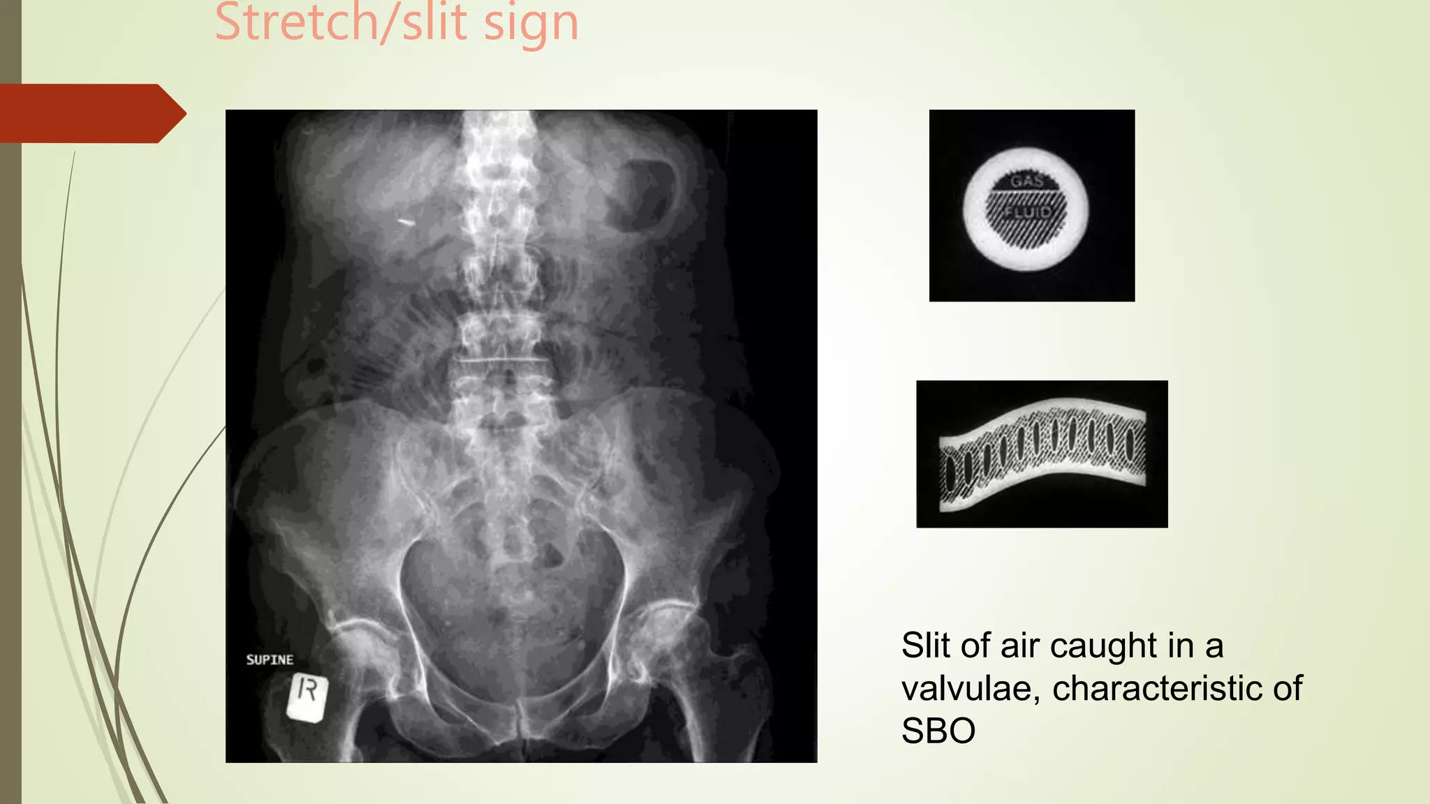 Abdominal x-ray interpretation ppt | PPTX