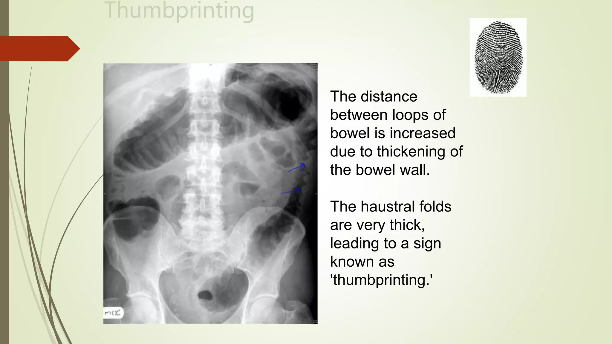 Abdominal x-ray interpretation ppt | PPTX