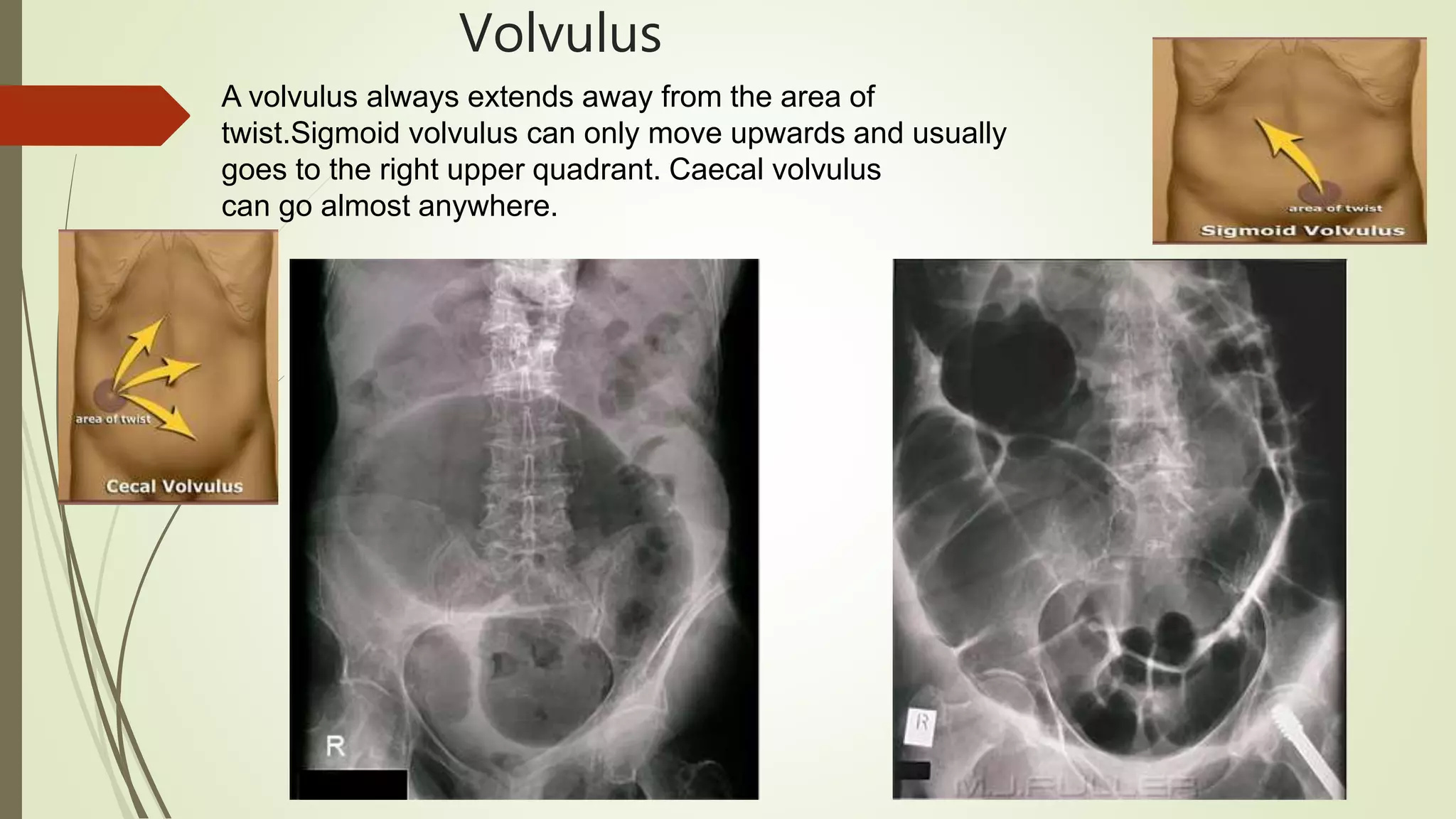 Abdominal x-ray interpretation ppt | PPTX