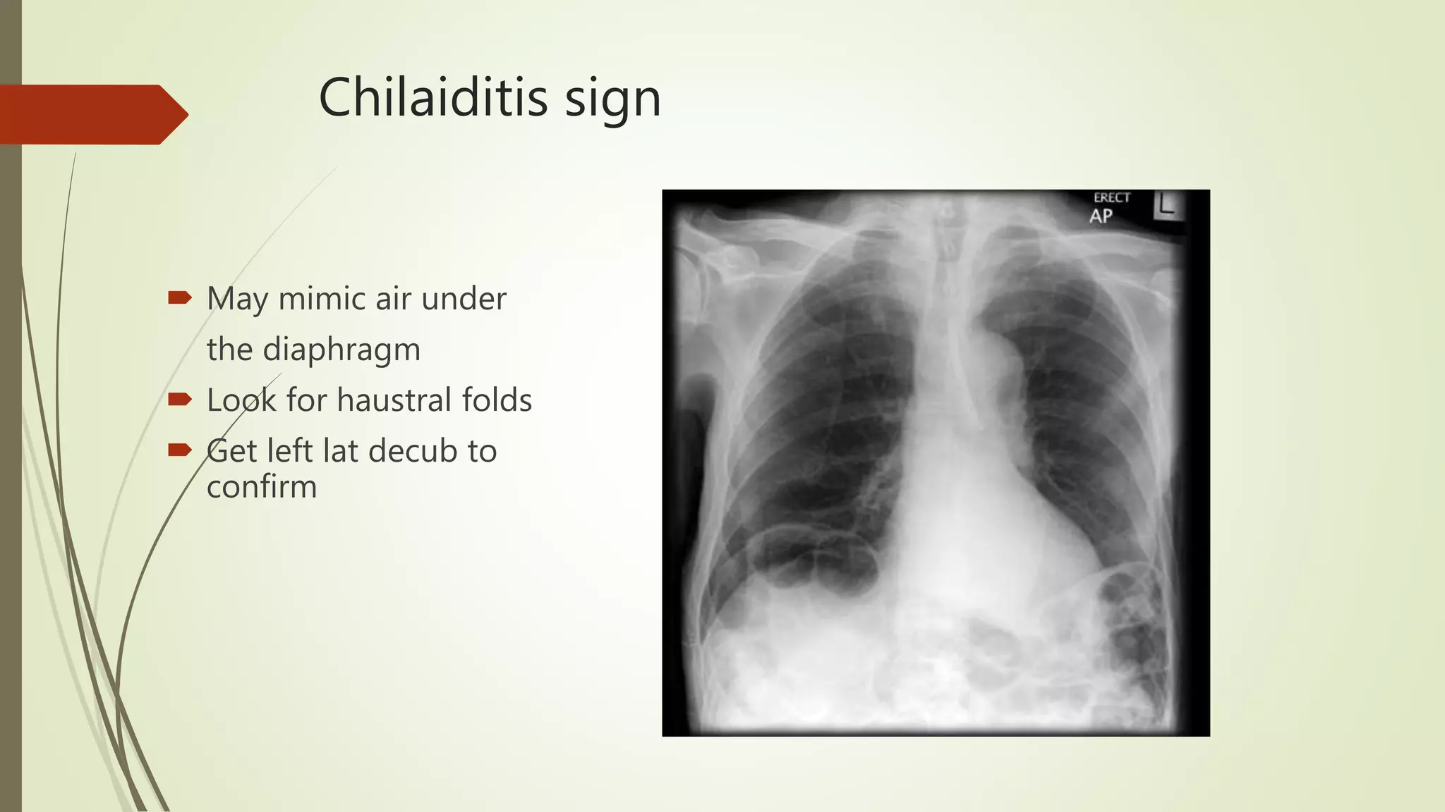 Abdominal x-ray interpretation ppt | PPTX