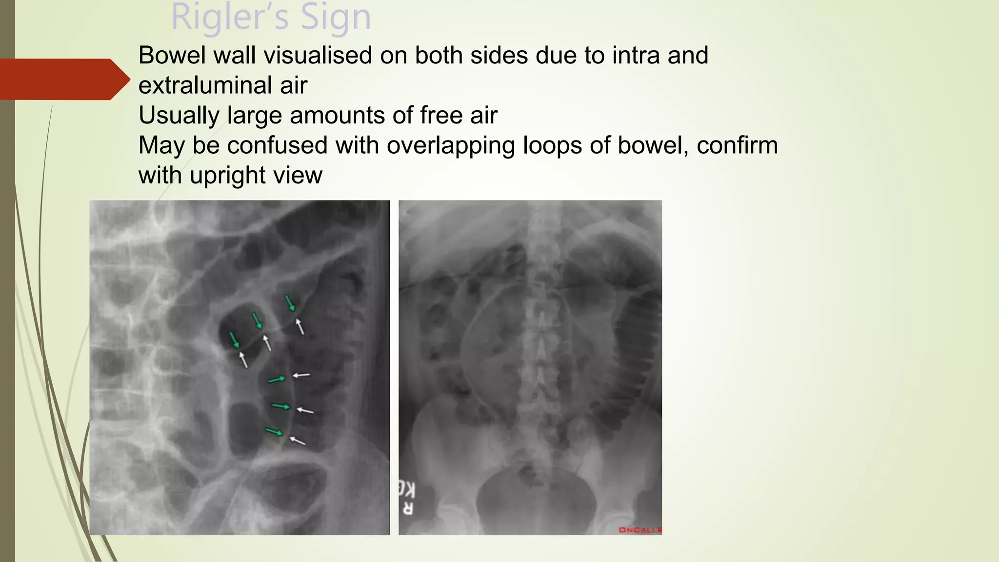 Abdominal x-ray interpretation ppt | PPTX