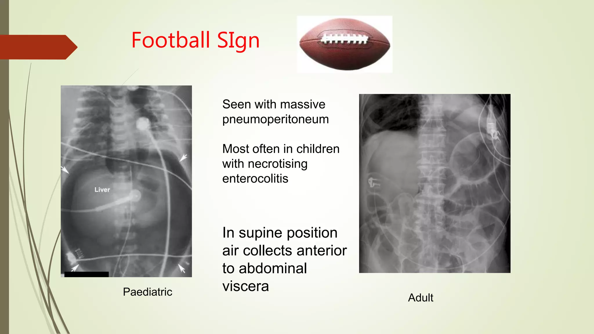Abdominal x-ray interpretation ppt | PPTX