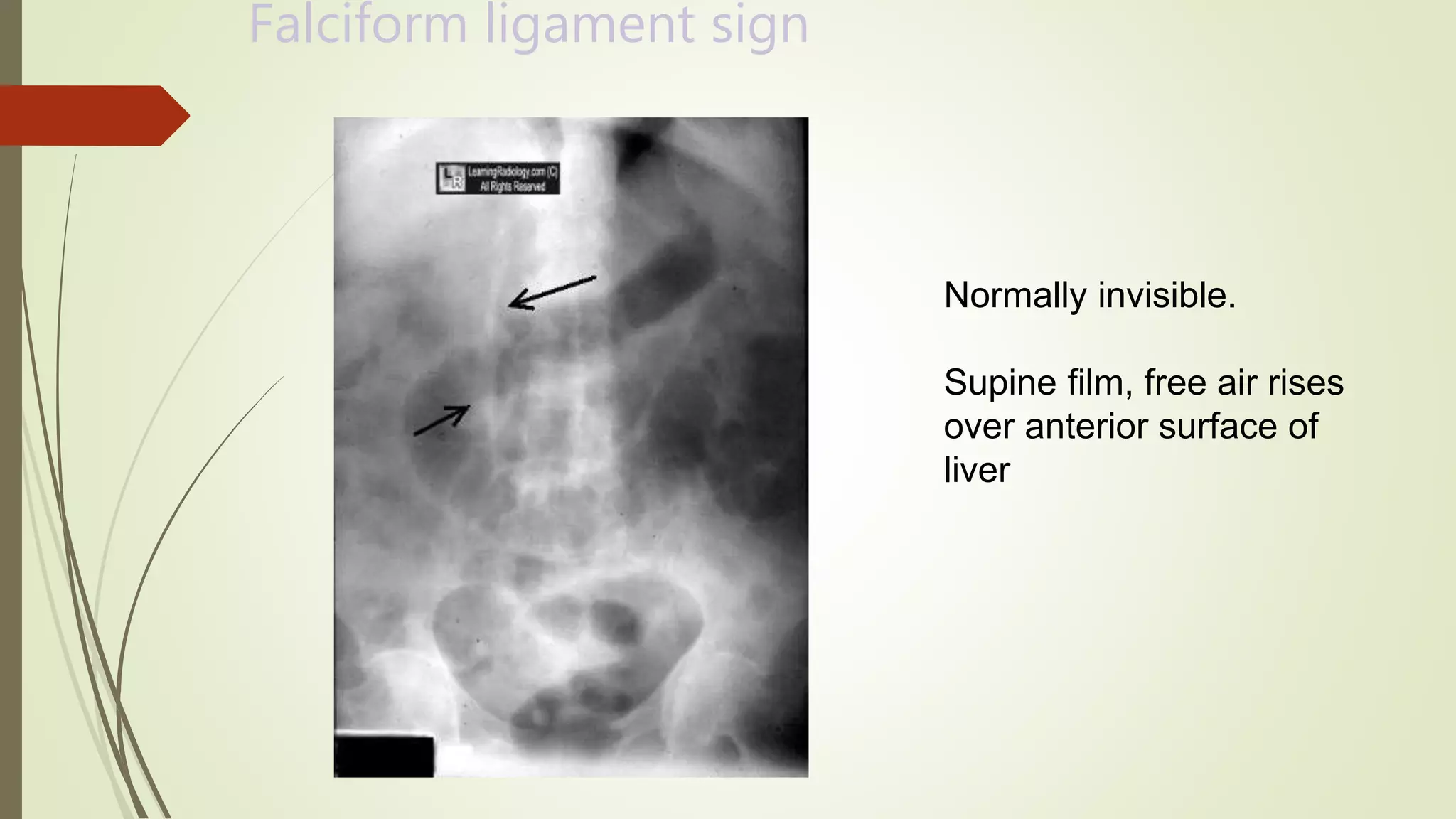Abdominal x-ray interpretation ppt | PPTX