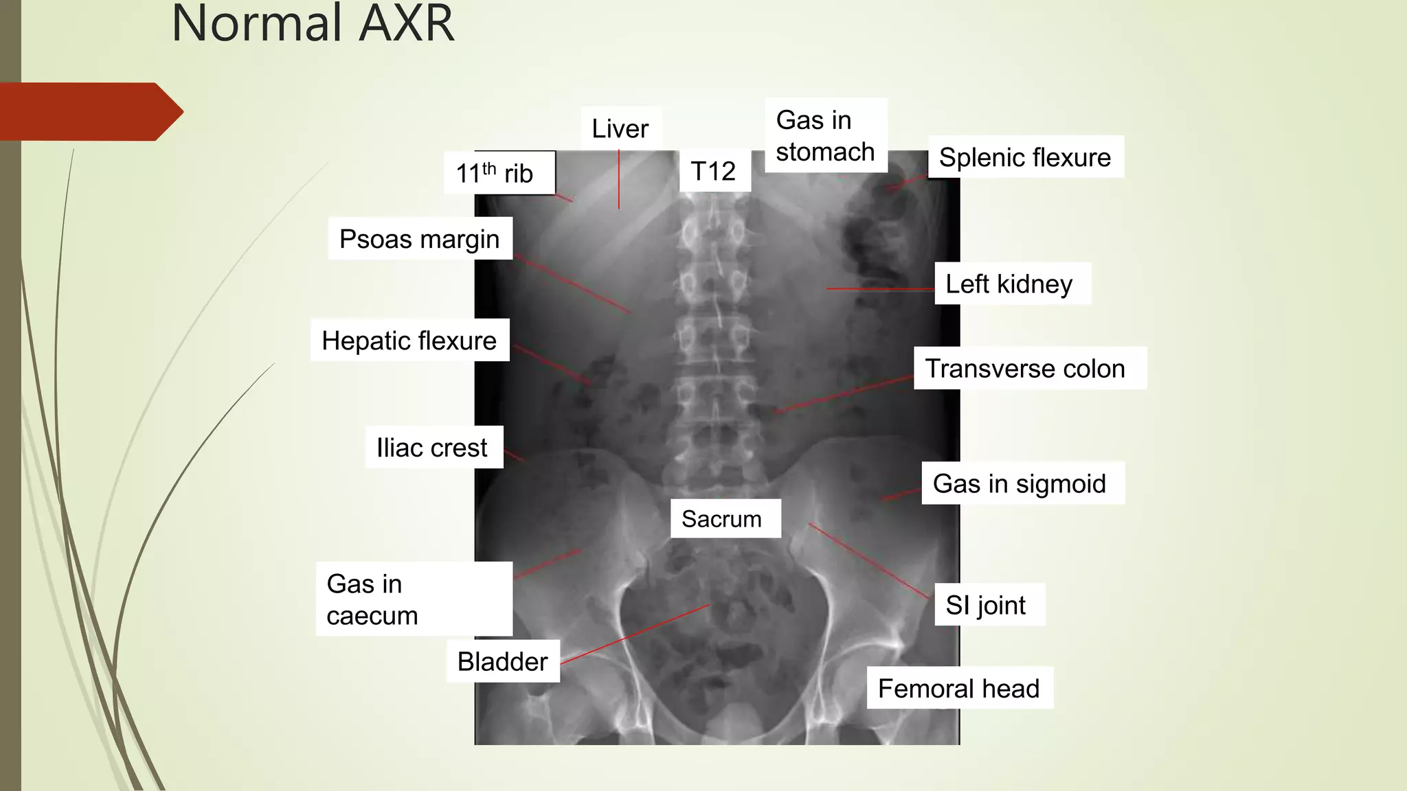Abdominal x-ray interpretation ppt | PPTX