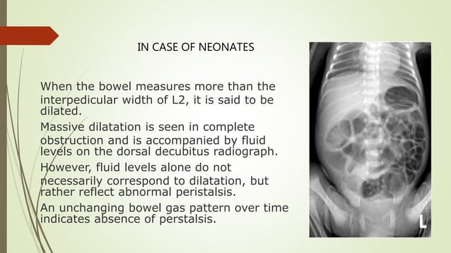 Abdominal x-ray interpretation ppt | PPTX | Digestive Disorders ...