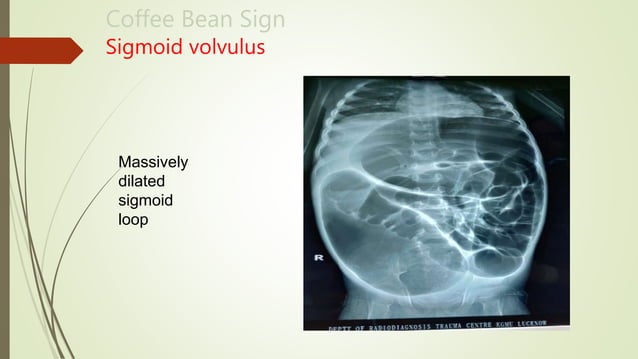 Abdominal x-ray interpretation ppt | PPTX | Digestive Disorders ...