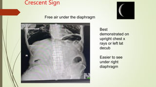 Abdominal x-ray interpretation ppt | PPTX