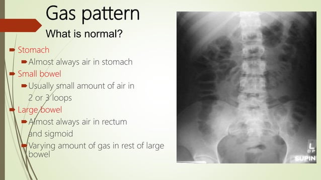 Abdominal x-ray interpretation ppt | PPTX | Digestive Disorders ...