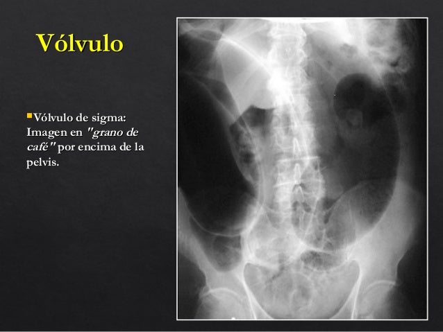 Abdomen agudo en radiologia