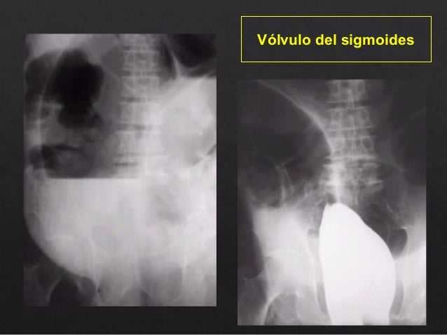 Abdomen agudo en radiologia