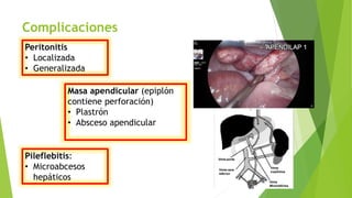 Abdomen agudo inflamatorio - Apendicitis.pptx