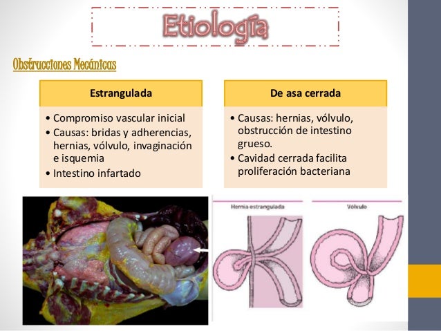 Abdomen agudo obstructivo