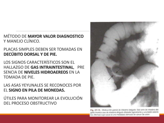 fisiopatologia de abdomen agudo obstructivo.pptx