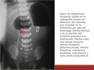 fisiopatologia de abdomen agudo obstructivo.pptx
