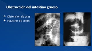 ABDOMEN AGUDO OBSTRUCTIVO en cirugia.pptx