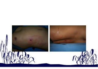 Presentasi untuk penyuluhan Abdomen Akut | PDF