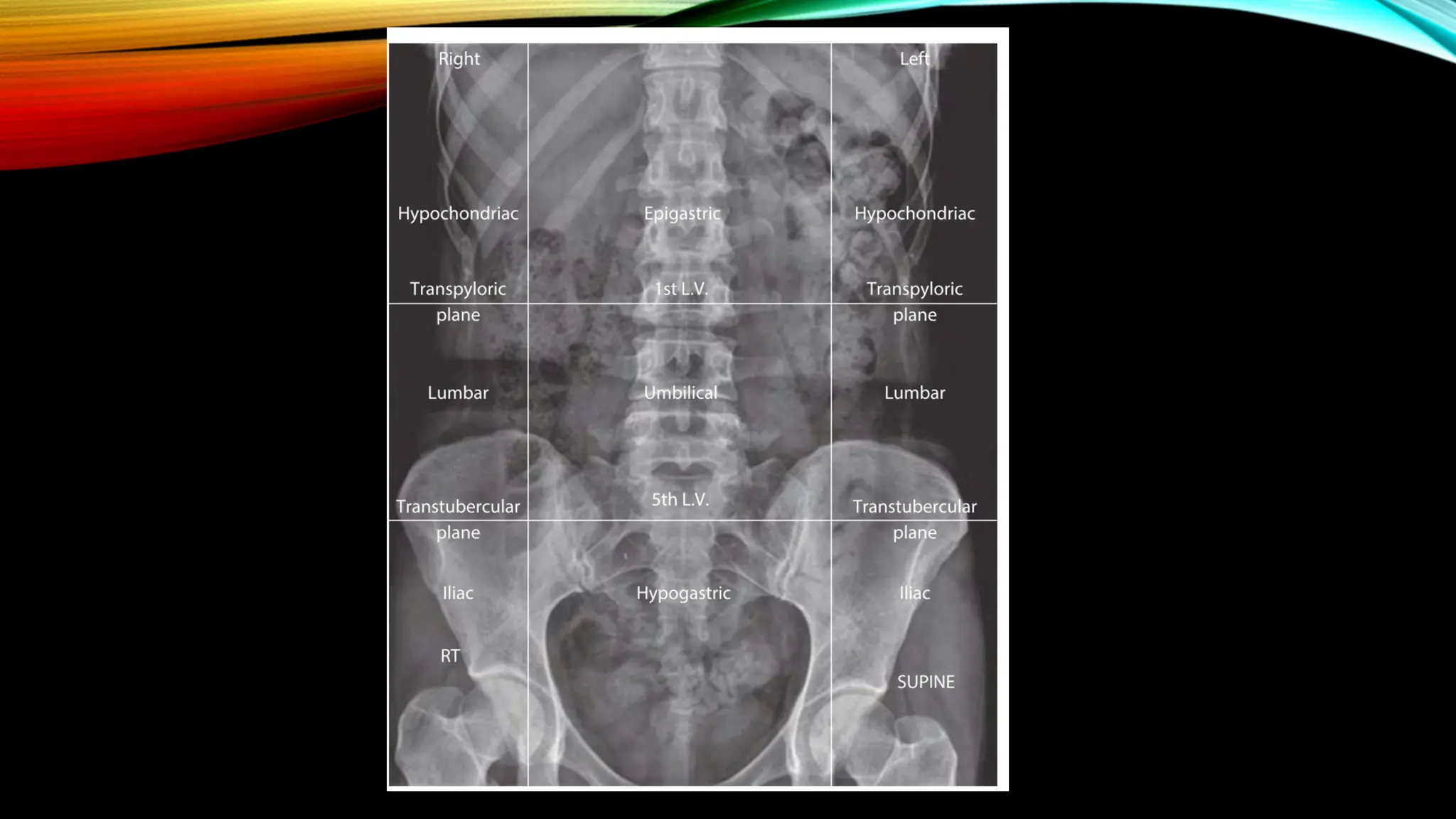 Abdomen and pelvis radiography in practise .ptx