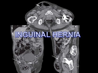 Abdomen ct patho 3 | PPTX