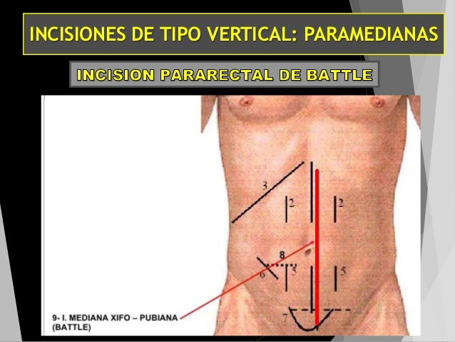 Abdomen e Insiciones quirugicas