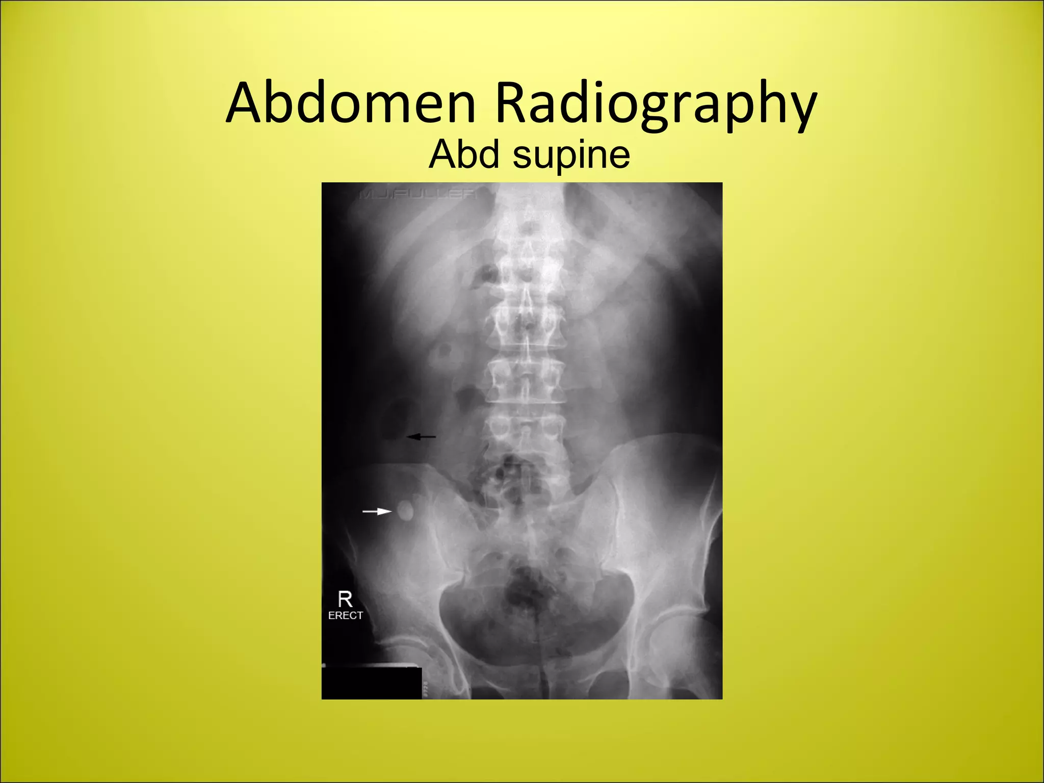Abdomen Radiography ppt . Daniel J.P. Radiology Technologist ...