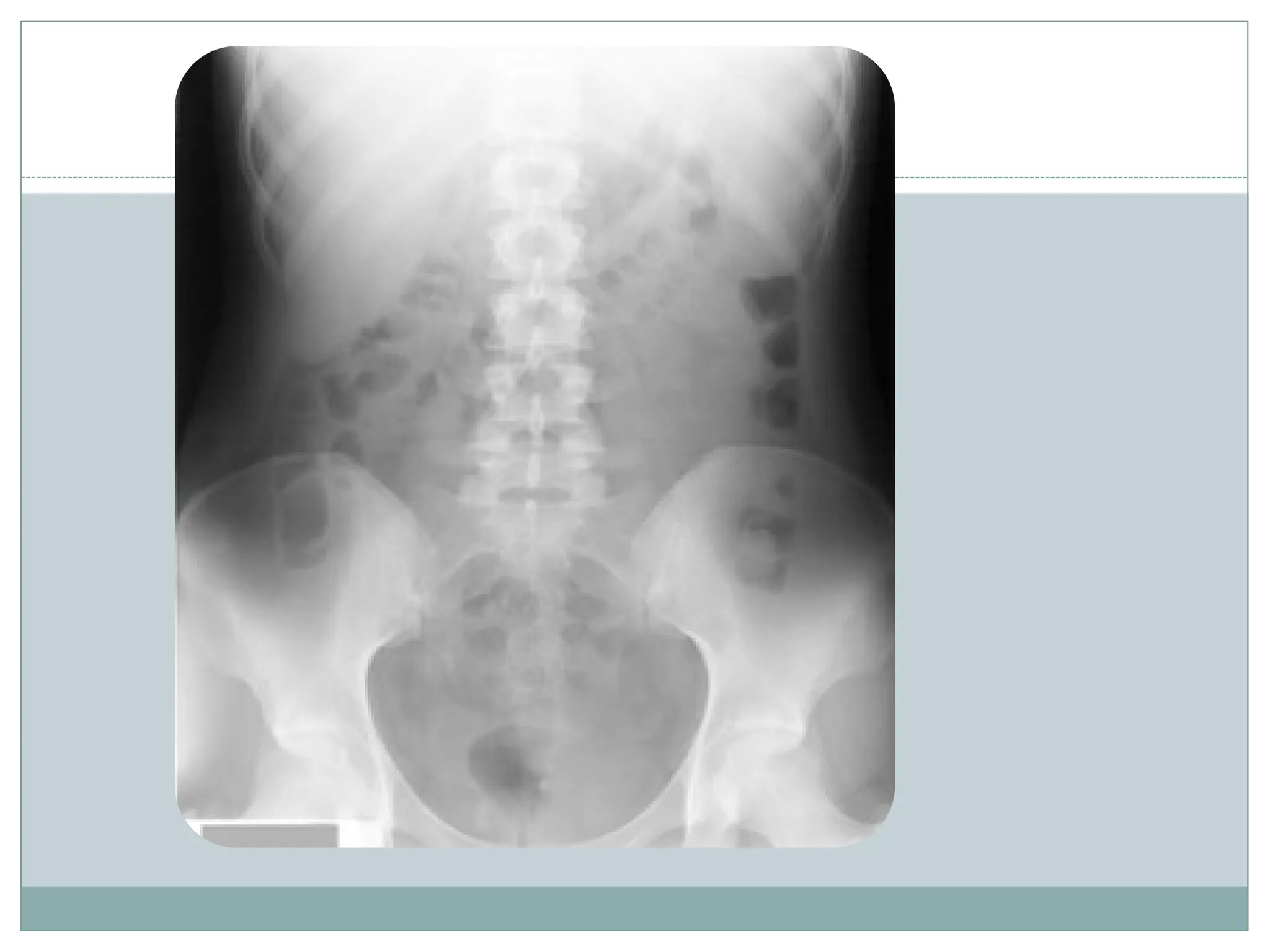 Abdomen simple, anatomia normal, clasificacion de.pptx