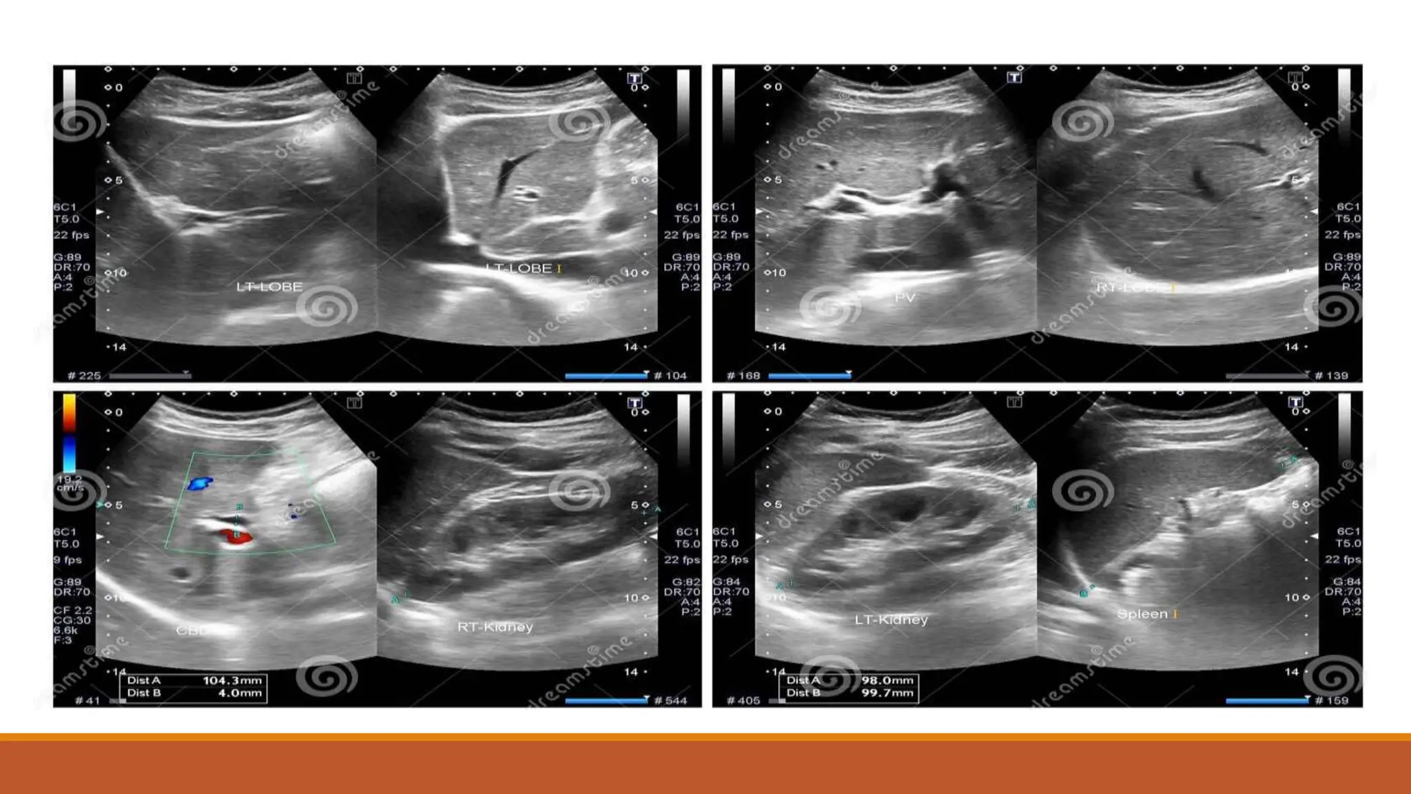 Abdomen ultrasound.pptx