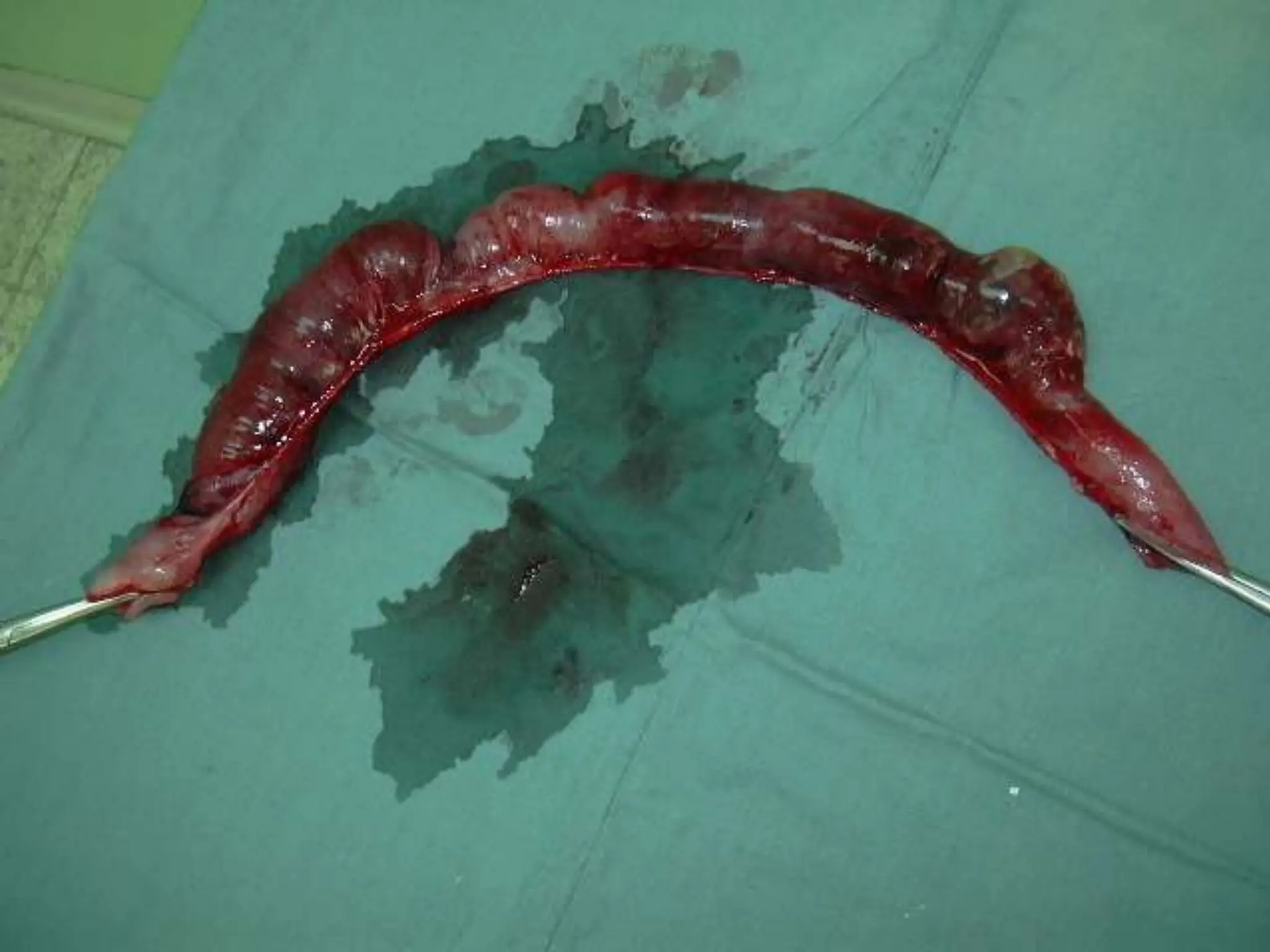 abdomen wall defects in neonate,exomphalos.ppt