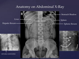 X Ray Normal Abdomen | PPTX