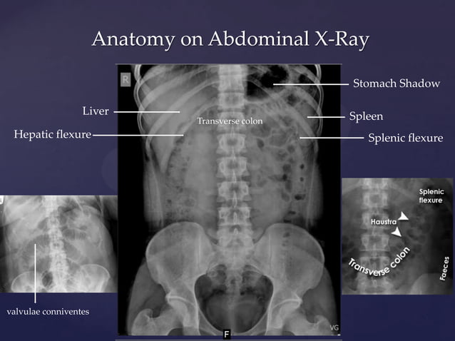 X Ray Normal Abdomen | PPTX