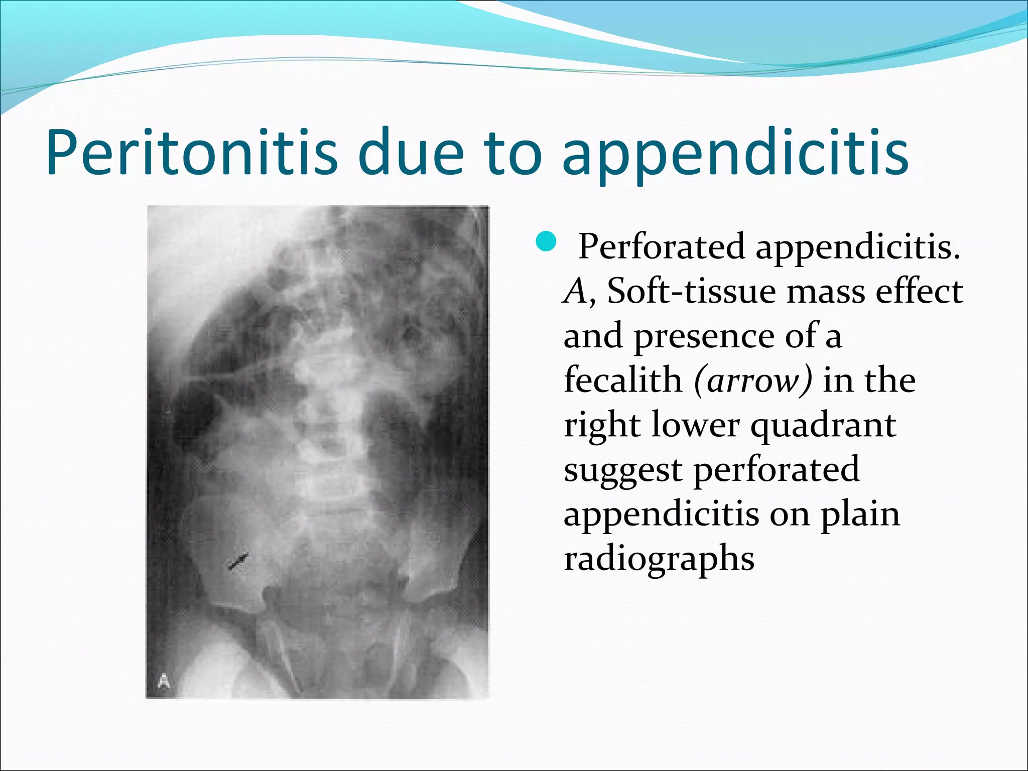 Abdominal xray images | PPT