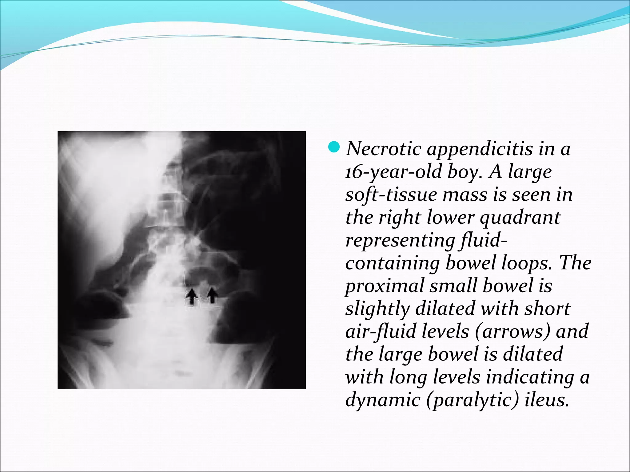 Abdominal xray images | PPT