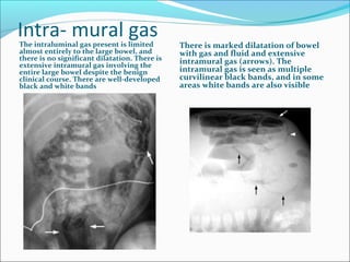Abdominal xray images | PPT