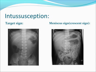 Intussusception Crescent Sign