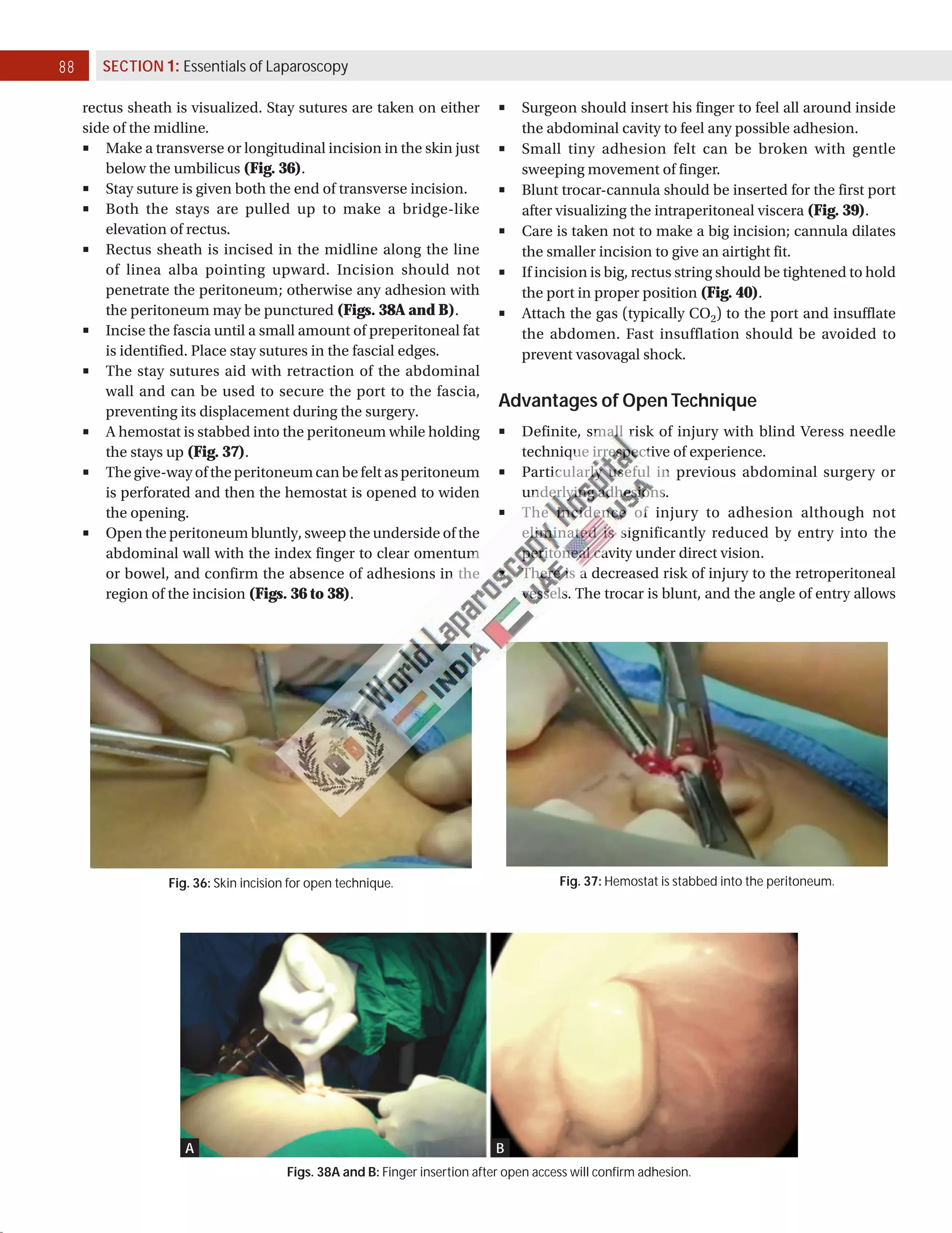 Abdominal access-techniques | PDF