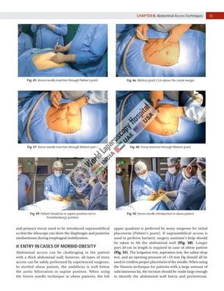 Abdominal Access Techniques with Prof. Dr. R K Mishra | PDF