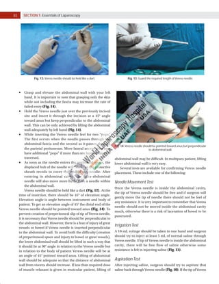 Abdominal Access Techniques in Laparoscopy.pdf