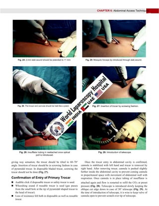 Abdominal Access Techniques at world laparoscopy hospital | DOC