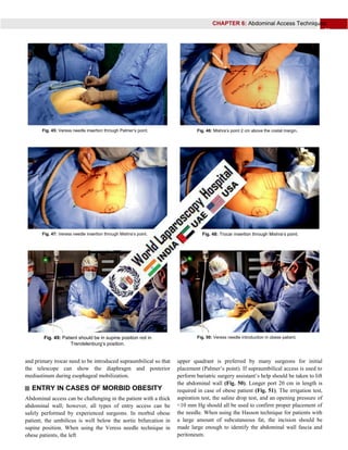 Abdominal Access Techniques at world laparoscopy hospital | DOC