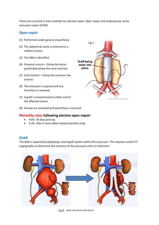 Abdominal Aortic Aneurysms | PDF
