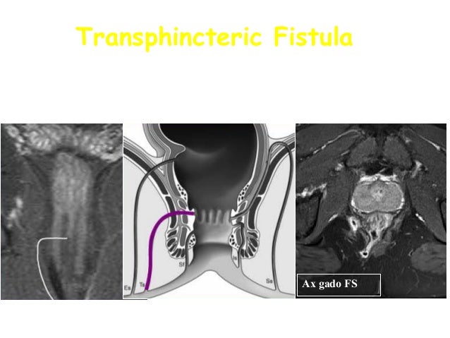 Abdominal imaging ano fistula jm tubiana