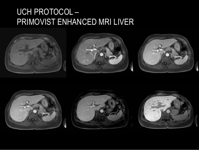 Abdominal imaging hcc t loke
