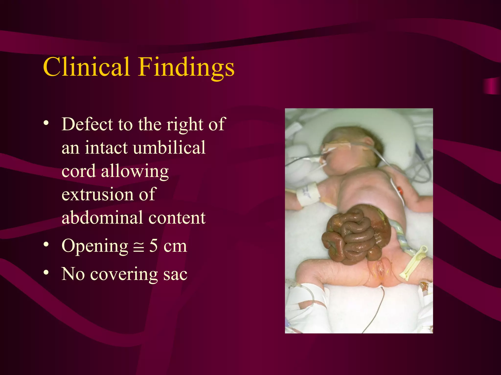 Abdominal wall-defects | PPT
