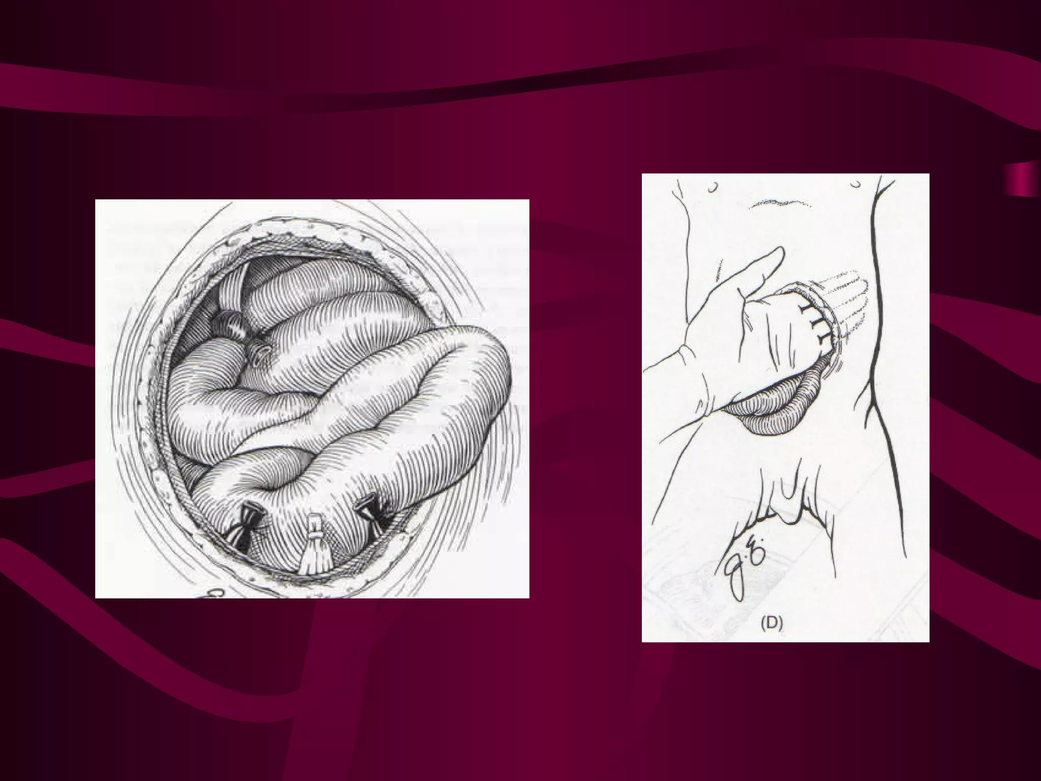 Abdominal wall-defects | PPT