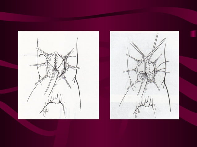 Abdominal wall-defects | PPT | Pregnancy | Reproductive Health