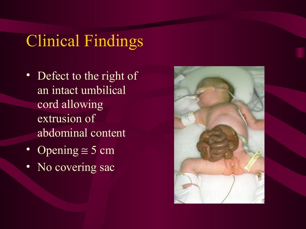Abdominal wall-defects