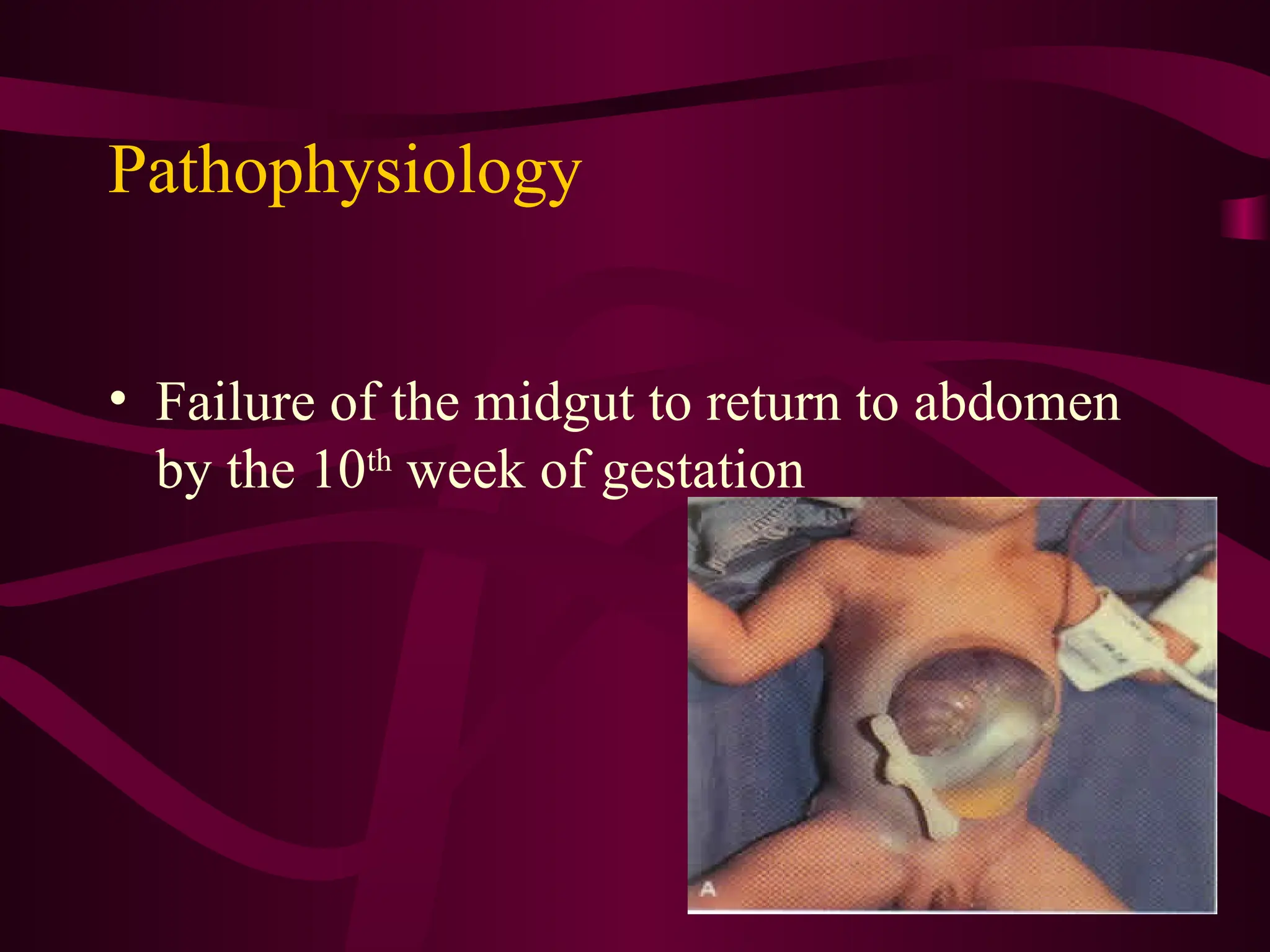 Abdominal-Wall-Defects.ppt by batte John Marvin. | PPT