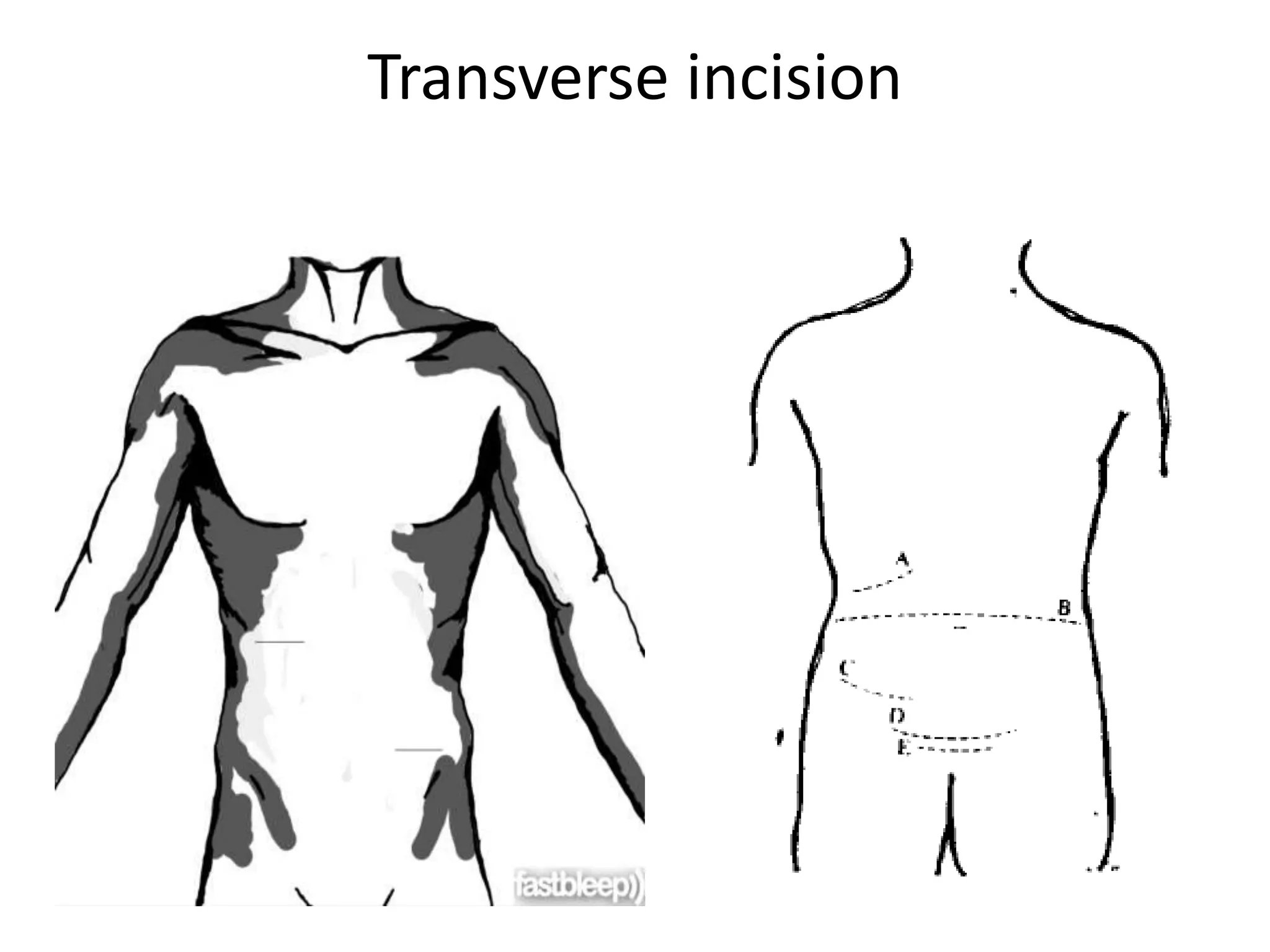 Abdominal access presentation | PPTX