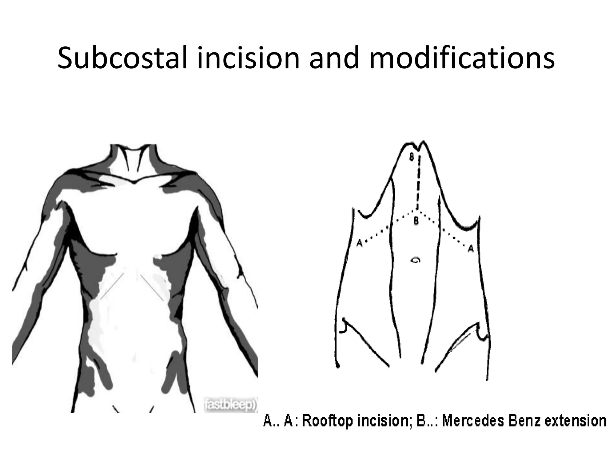 Abdominal access presentation | PPTX